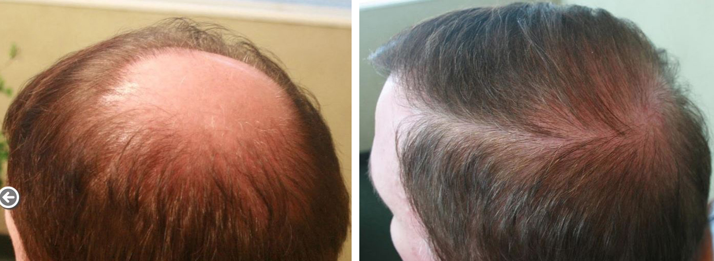 Bald Spot Hair Transplant Hair Transplant Web